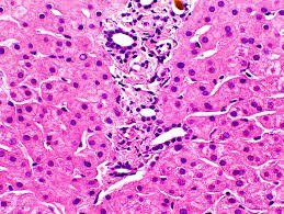 fibrosis hepática avanzada | ASSCAT
